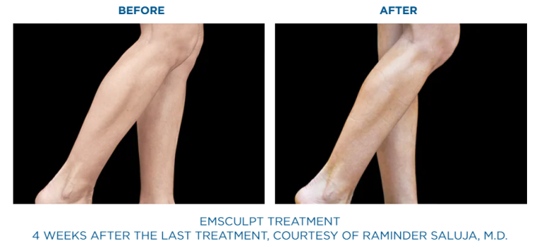 EMSCULPT NEO®: Before and After Transformations for Thighs, Arms, and ...